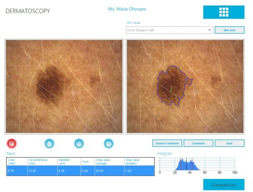 Dermatoscope|Visioscope® PC 35 Skin Analysis Camera| MEDELINK